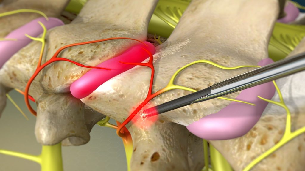 Endoscopic Rhizotomy | Scottsdale, AZ Orthopedic Spine Surgery