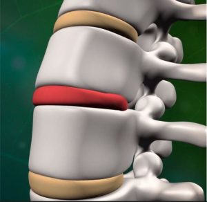 Lumbar Degenerative Disc Disease | Scottsdale, AZ Orthopedic Spine Surgery