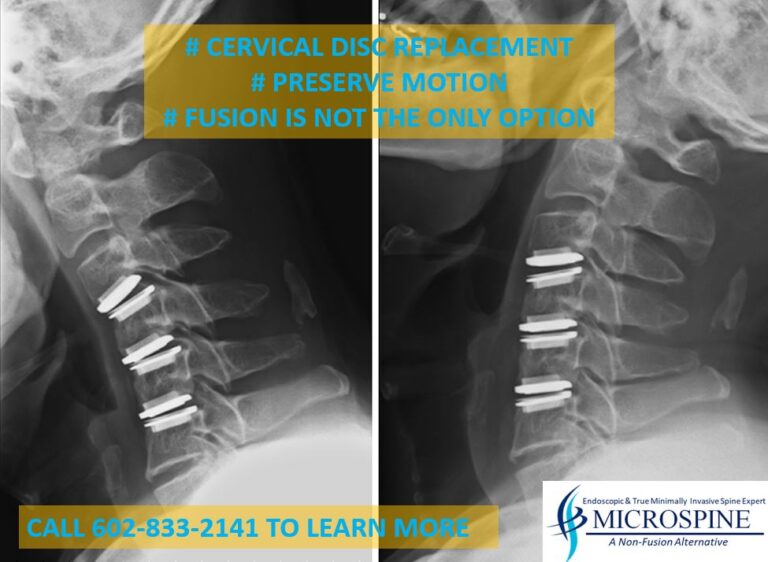 When To Consider Spinal Disc Replacement? | Microspine PLC
